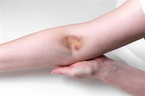 How Does Leukemia Bruising Differ From A Normal Bruise