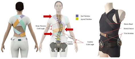 Scoliosis Brace