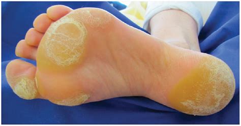 Hyperkeratosis Feet