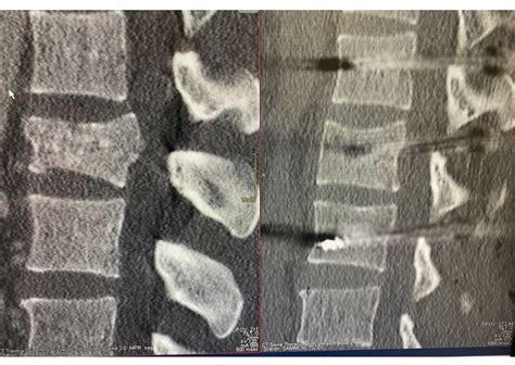 L2 Incomplete Burst Fracture A Young Man 40s Non Us Citizen Fell At