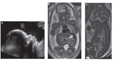 Skeletal Dysplasia Radiology Key