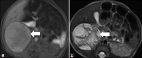 Multimodality Imaging Of Adrenal Gland Pathologies A Comprehensive