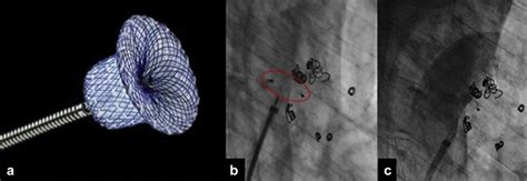 A Illustrative Image Of Amplatzer Patent Ductus Arteriosus Pda