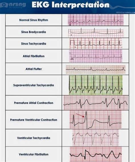 Ekg Interpretation Medizzy