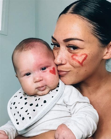 Laser Treatment For Port Wine Stain Birthmark Aussie Mum Hits Back