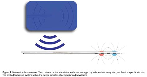 Novel Minimally Invasive Wireless Nanotechnology Neuromodulation System