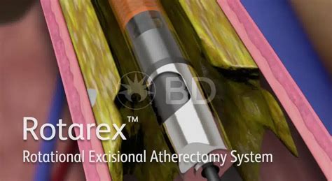 Rotarex™ Rotational Excisional Atherectomy System Elevate Your