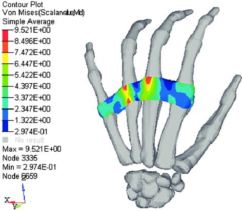 Simulated Von Mises Stress Distribution Mpa Download Scientific