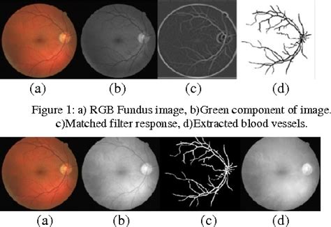 Figure 1 From Automatic Segmentation Of Optic Disc Using Modified Multi Level Thresholding