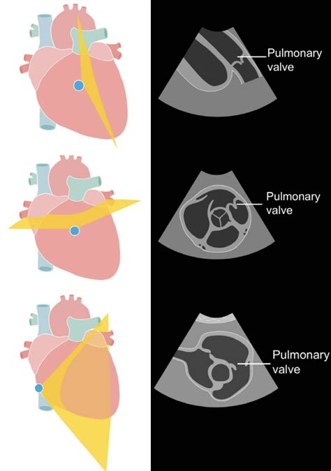 Echo Basics Pulmonary Valve • Litfl • Radiology Library
