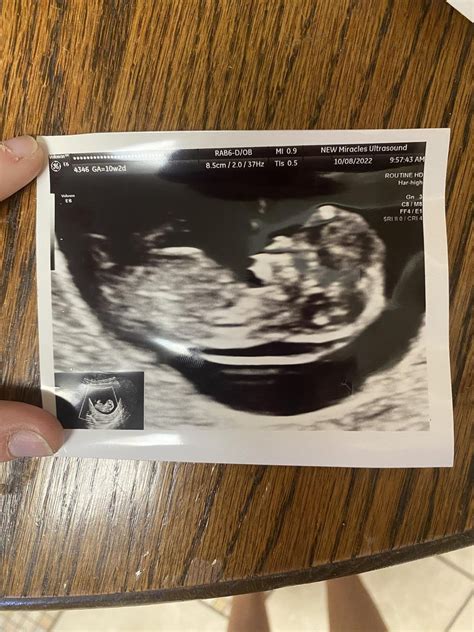 Atypical Finding On Sex Chromosomes Rnipt