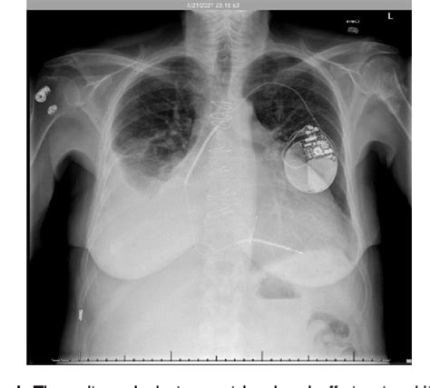 Figure 1 From A Case Of Hydropneumothorax Semantic Scholar