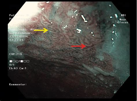 Bing Classification Early Barrett Neoplasia Endoscopy Campus