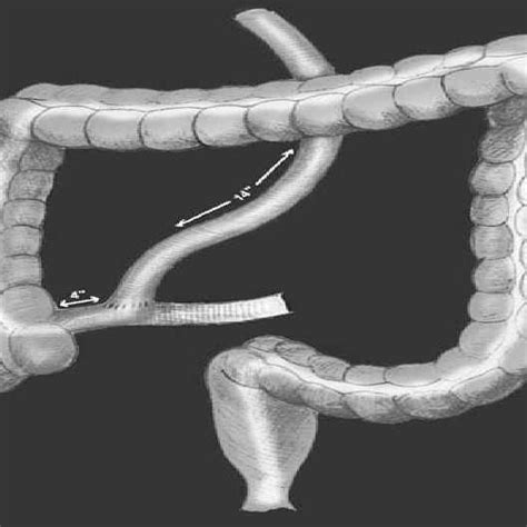 1969 Payne And Dewind Jejunoileal Bypass 35 To 10 Cm 14 To 4