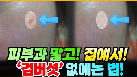 피부과말고 집에서 검버섯 없애는 방법 기미 피부 Youtube