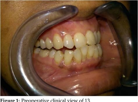 Figure 1 From A Split Mouth Comparison Of Minimally Invasive Vs