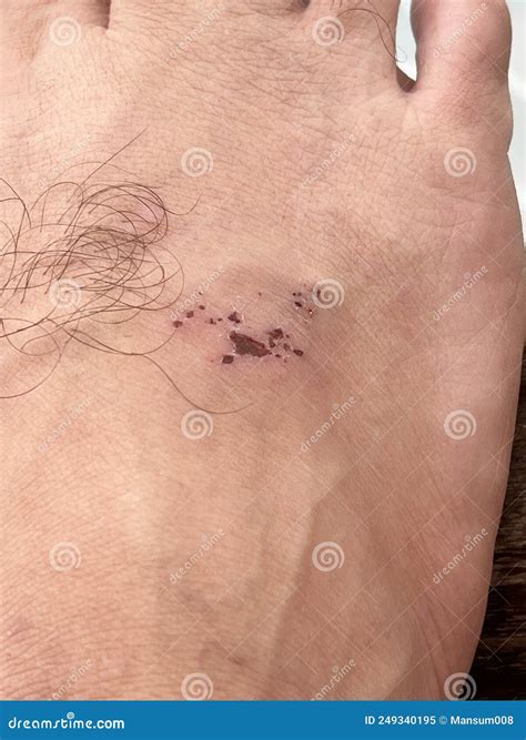 Scar After Scab At Marilyn Stumpf Blog