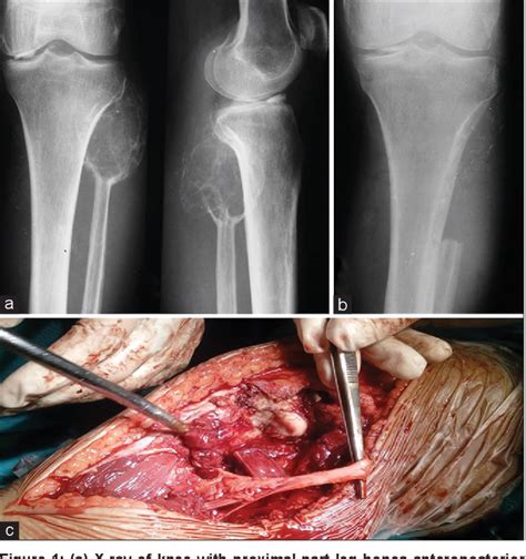 Figure 1 From Fibulectomy For Primary Proximal Fibular Bone Tumors A Functional And Clinical