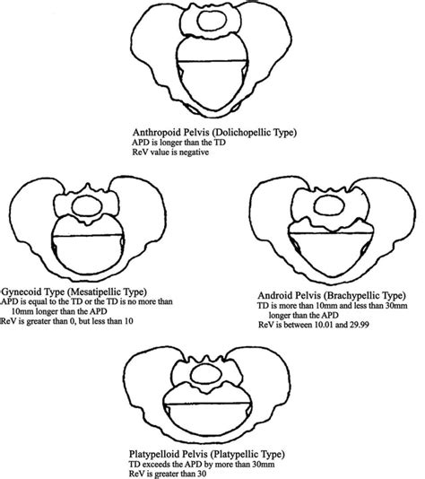 Anthropoid Pelvis Dolichopellic Type Apd Is Longer Than The Td Rev