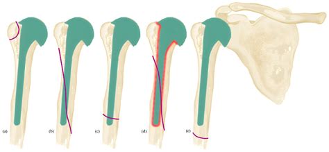 Inter Observer And Intra Observer Reliability Assessment Of The