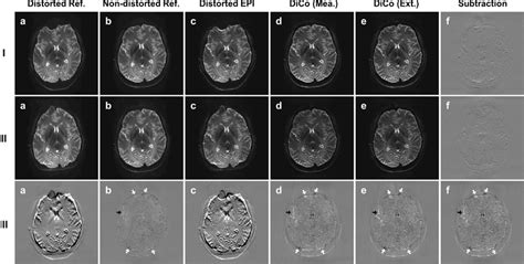 Distortion Correction With Forward Row I And Reverse Row Ii Se Epis Download Scientific