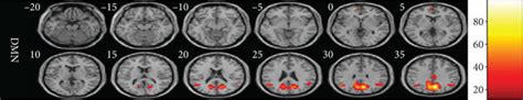 Aberrant Functional Connectivity In The AUN DMN DAN LFPN And VIN