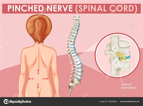 Diagram Showing Pinched Nerve In Human Stock Vector Image By