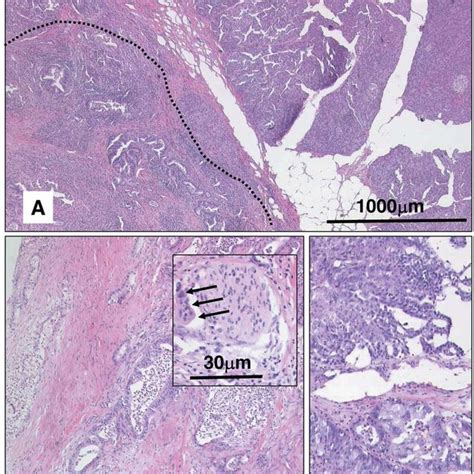 Histomorphology Of Pancreatic Ductal Adenocarcinoma Pdac And Of The