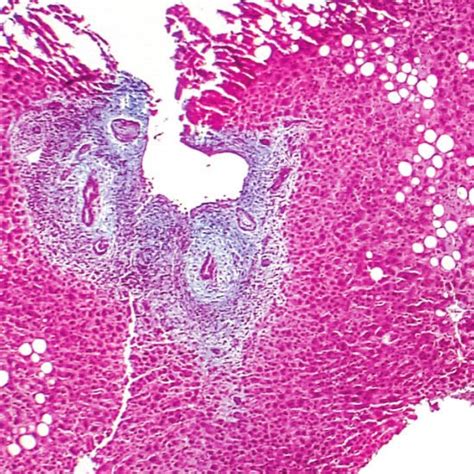 Trichrome X40 Liver Biopsy Low Power View Demonstrating A Focal