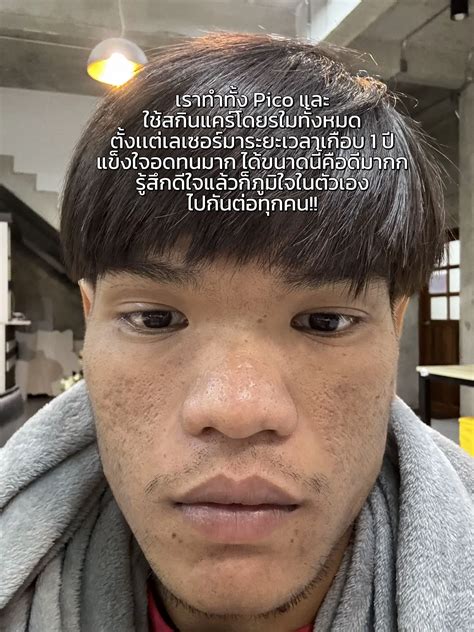 หน้าพัง Vs Pico Laser 4 ครั้ง พังหรือรอด‼️ แกลเลอรีที่โพสต์โดย
