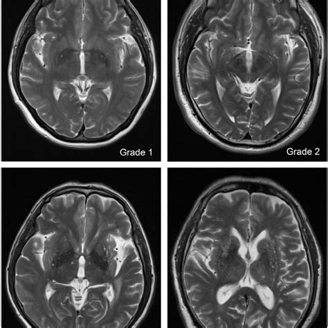 Severity Score Of Dilated Virchow Robin Spaces Dvrs In Hippocampus