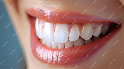 Smile Midprocedure Composite Bonding Highlighting Tooth Texture And