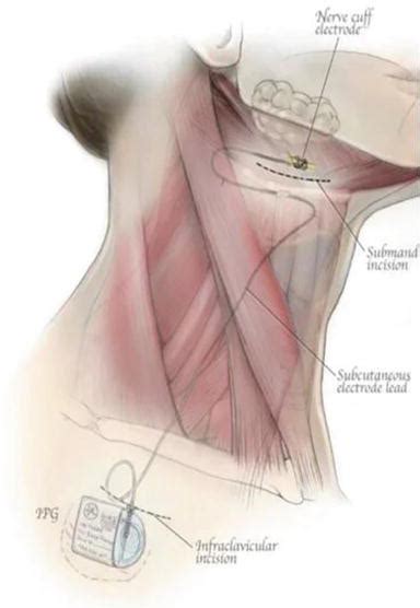 The Role Of Midline Glossectomy With Coblation In Obstructive Sleep Apnea Intechopen