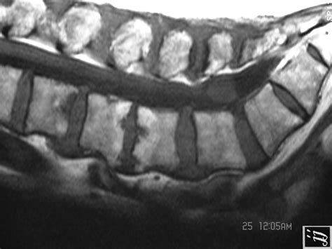Intradural L5 S1 Tumor T1 Radiopaedia