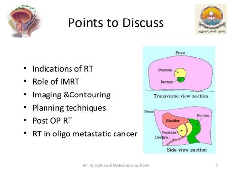 Imrt Prostate All About Radiation