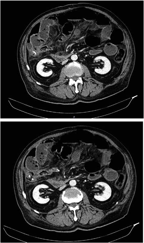 Ct Scans Of The Abdomen And Pelvis Demonstrating The Anstomostic