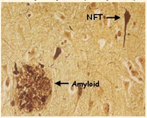 Molecular Basis Of Neurodegeneration And Nerve Growthrepair Alzheimer