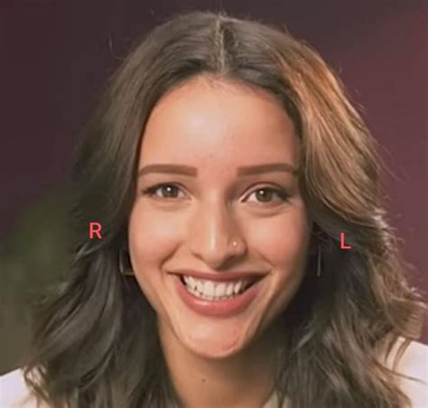 How To Fix This Type Of Assymetry Rorthotropics