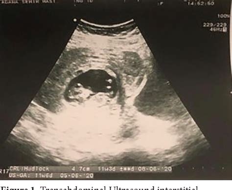 Figure 1 From Twelve Week Ruptured Interstitial Ectopic Pregnancy