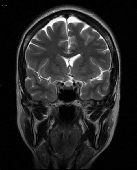 Coronal Mri Diagram Quizlet