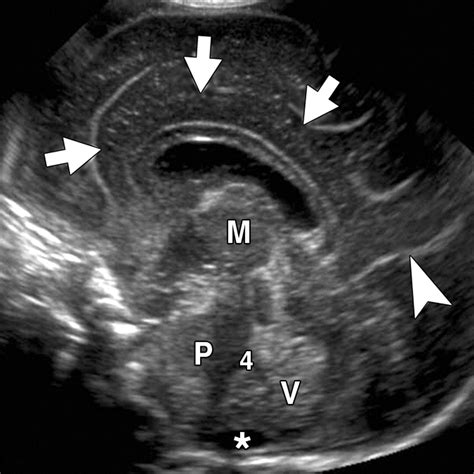 State Of The Art Cranial Sonography Part 2 Pitfalls And Variants Ajr