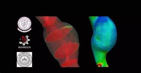 Aortic Rupture Detection Prediction And Prevention Using Computer