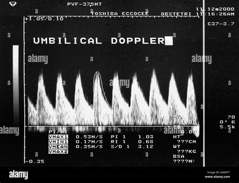 Umbilical Artery Doppler Normal Values