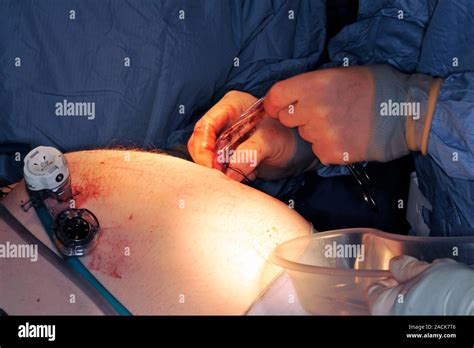 Gallbladder Removal Surgery Surgeon Removing A Patients Gallbladder