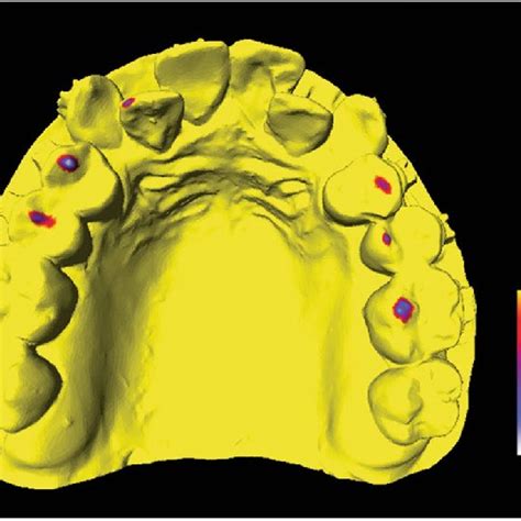 Pdf Surgical Occlusion Setup In Correction Of Skeletal Class Iii Deformity Using Surgery First
