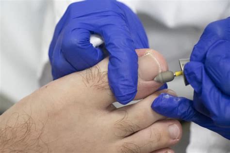 How To Treat A Cracked Toenail Feet First Clinic