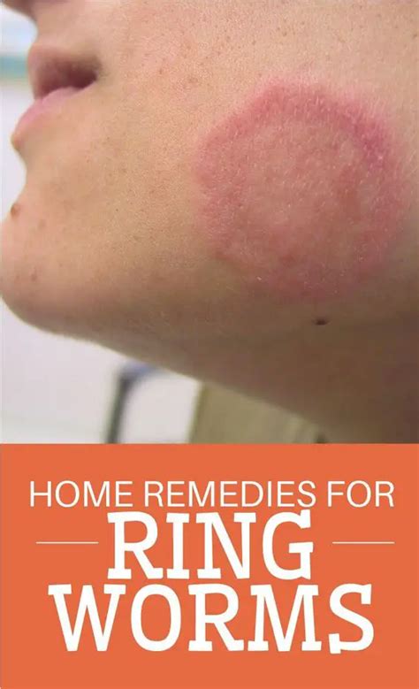 Healing Home Remedies For Ringworm The Homestead Survival
