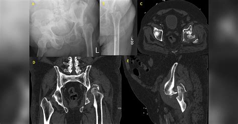Pipkin Type Fracture In Sale Brunofugaadvbr
