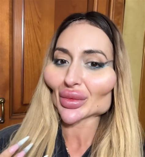 A Woman Gets Multiple Surgeries To Have The Worlds Biggest Cheeks” Shares Photos Bright Side