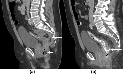 Transanal Endoscopic Microsurgery For Rectal Cancer Clinical Radiology
